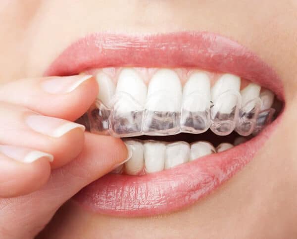 Retainers Belfast | Shankill Bank Orthodontic Practice